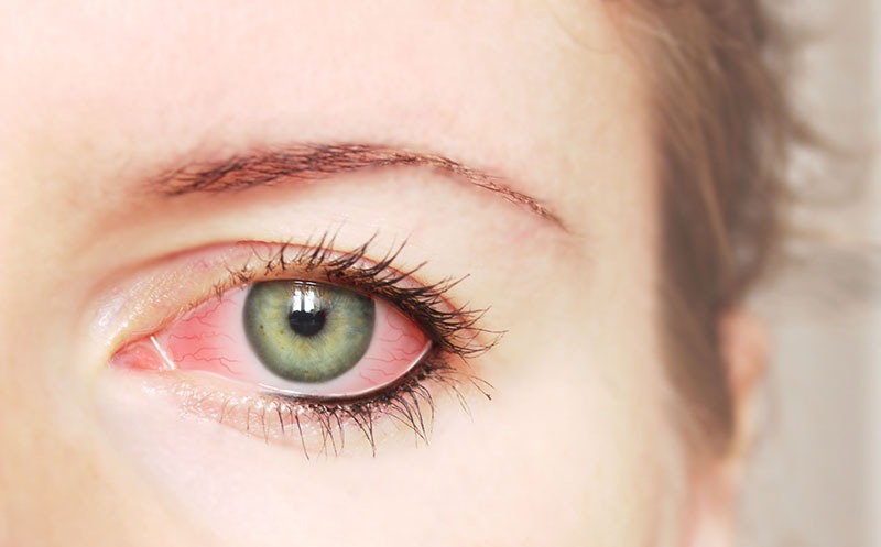 The symptoms and causes of Keratoconjunctivitis (EKC) - Swisscoat Europe