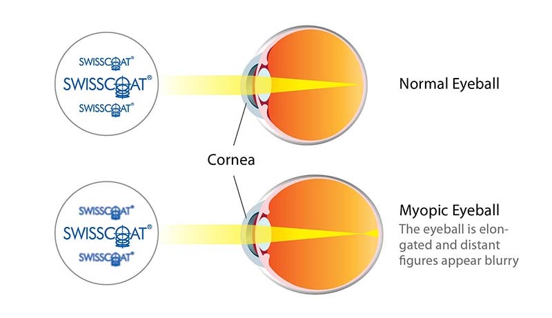 High Myopia is a Risk Factors of Various Eye Diseases - Swisscoat Europe